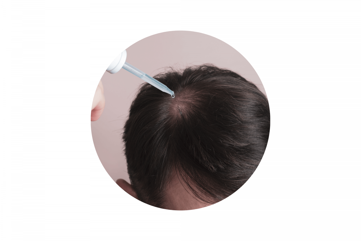 Les 5 meilleurs traitements non chirurgicaux pour la perte de cheveux ...