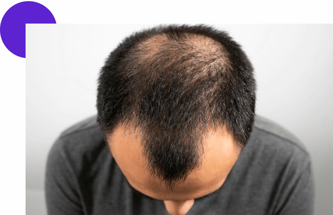 Les solutions pour les cheveux clairsemés chez l'Homme et la Femme