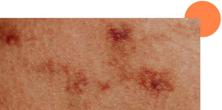 Rougeurs du corps : les solutions pour atténuer les plaques rouges