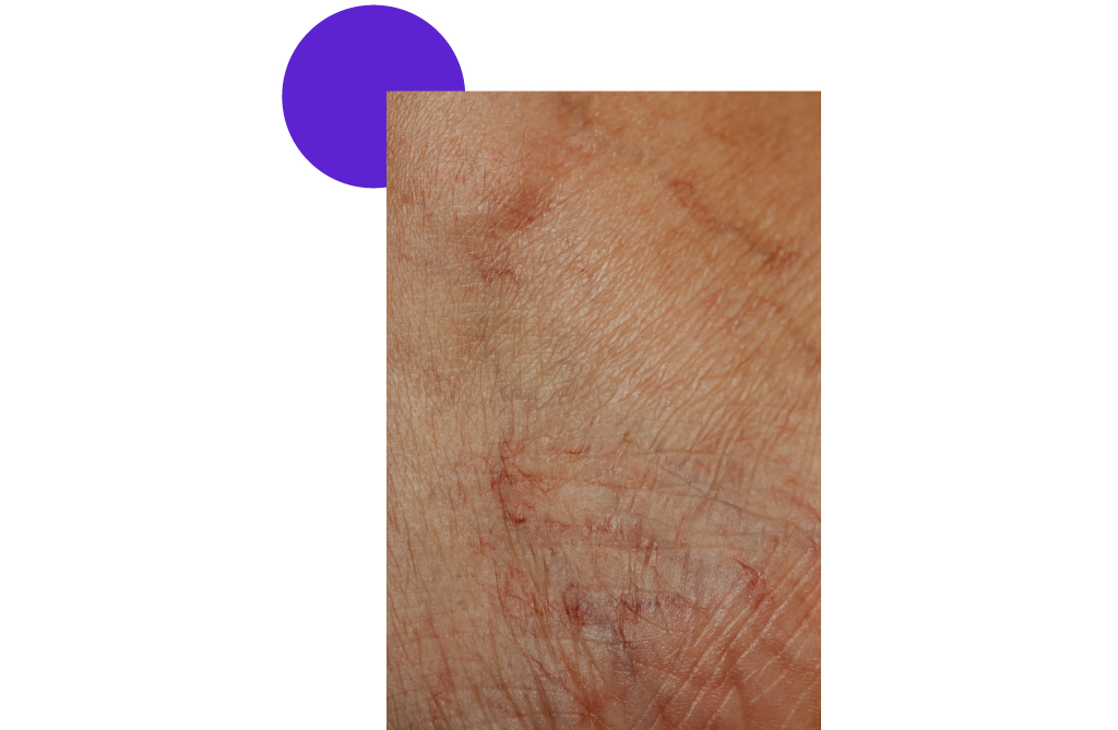 Rougeurs du corps : les solutions pour atténuer les plaques rouges