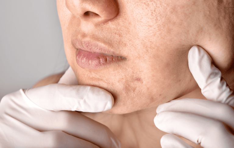 Acné liée au stress : éliminer les effets du stress sur la peau