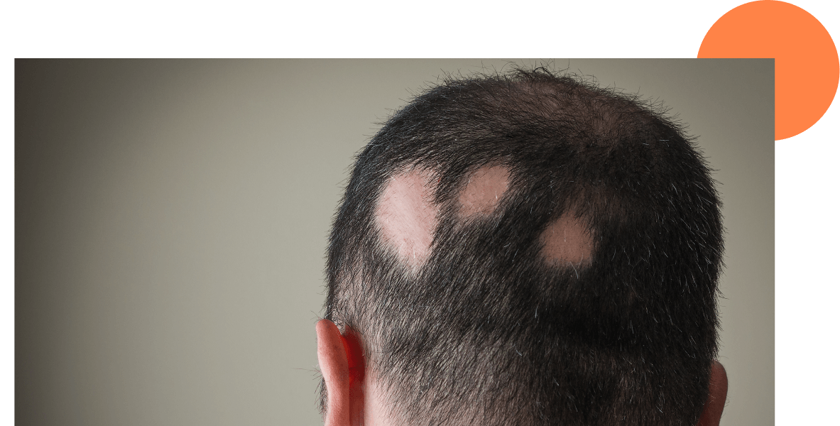 Alopécie cicatricielle : Que signifie cette perte de cheveux