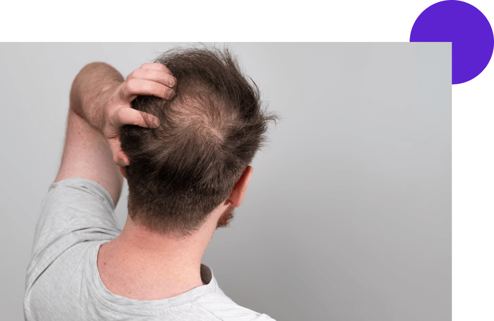 L'alopécie : Tout savoir sur la perte de cheveux