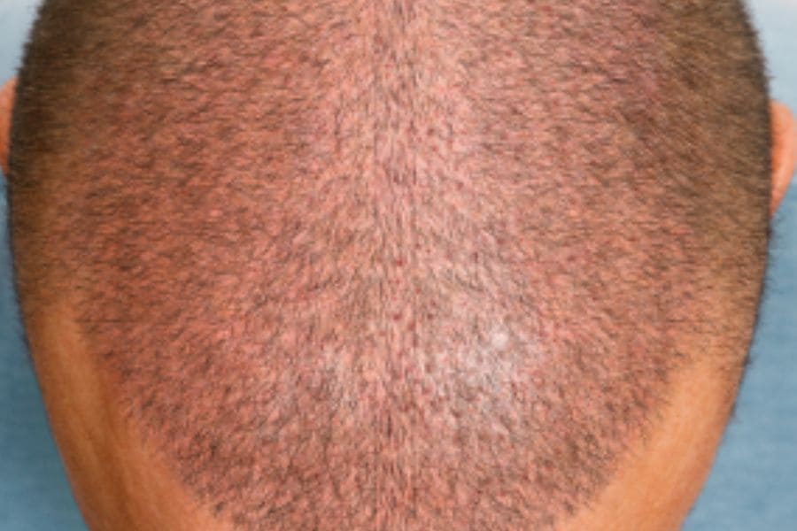 Greffe de cheveux : le guide de l'implant capillaire