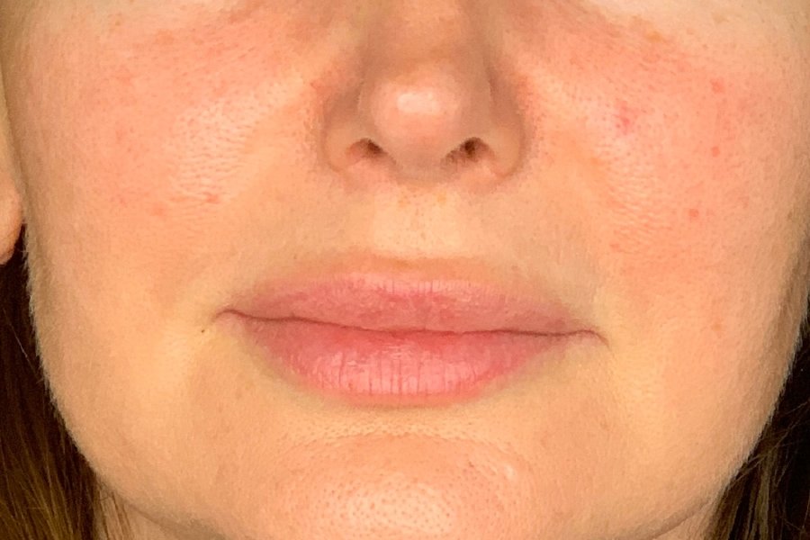 Laser vasculaire à Paris | Soins du visage | aesthé