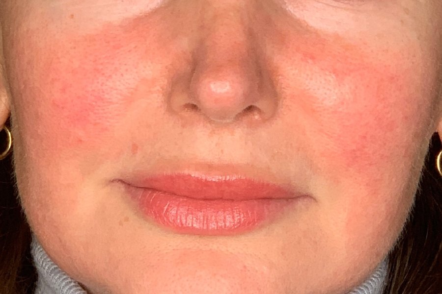 Laser vasculaire à Paris | Soins du visage | aesthé