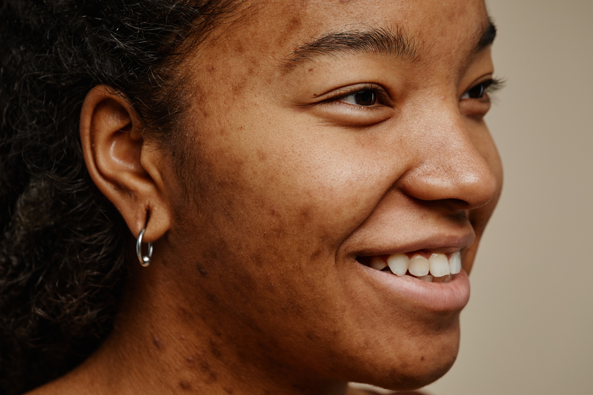 Avis patchs anti-boutons : est-ce efficaces contre les boutons d'acné