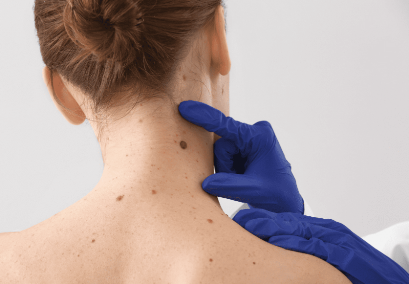 Comment enlever les grains de milium efficacement