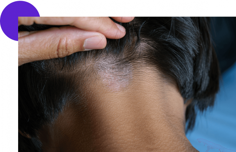 Teigne : quels sont les premiers symptômes et les traitements