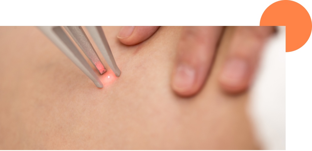 Laser vasculaire visage : médecine esthétique contre la couperose à Lille