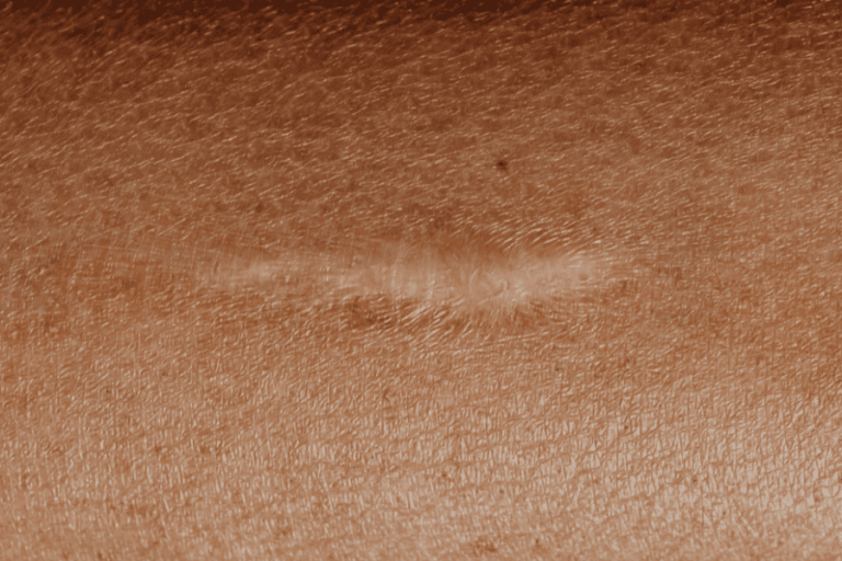 Les cicatrices : Comment les atténuer et les effacer