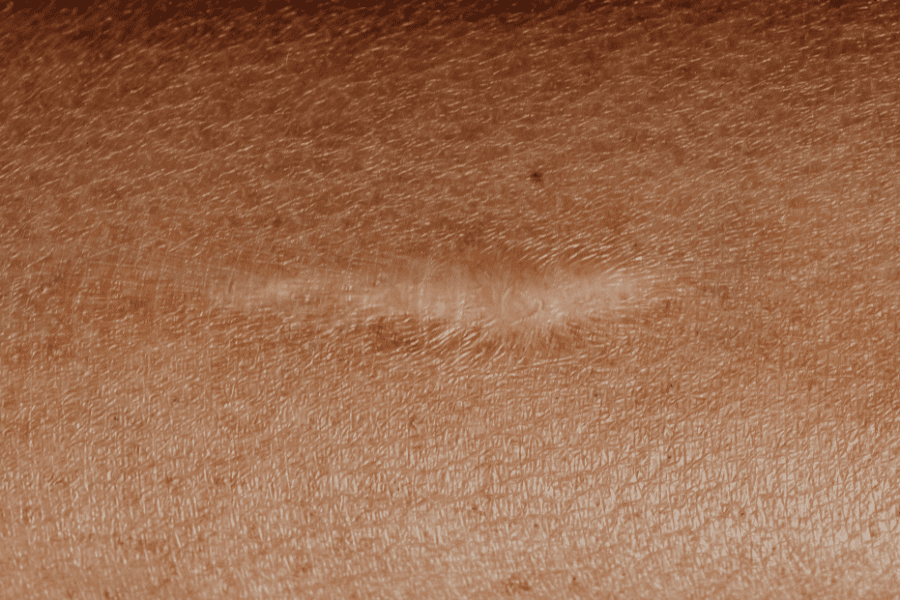 Les cicatrices : Comment les atténuer et les effacer