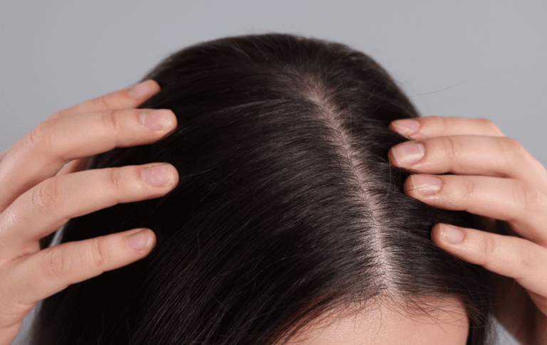 Mésothérapie du cuir chevelu : ralentir la chute des cheveux à Lille