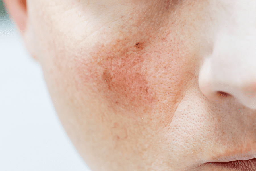 Couperose ou rosacée ou érythrose ? Comment reconnaitre et lutter ...