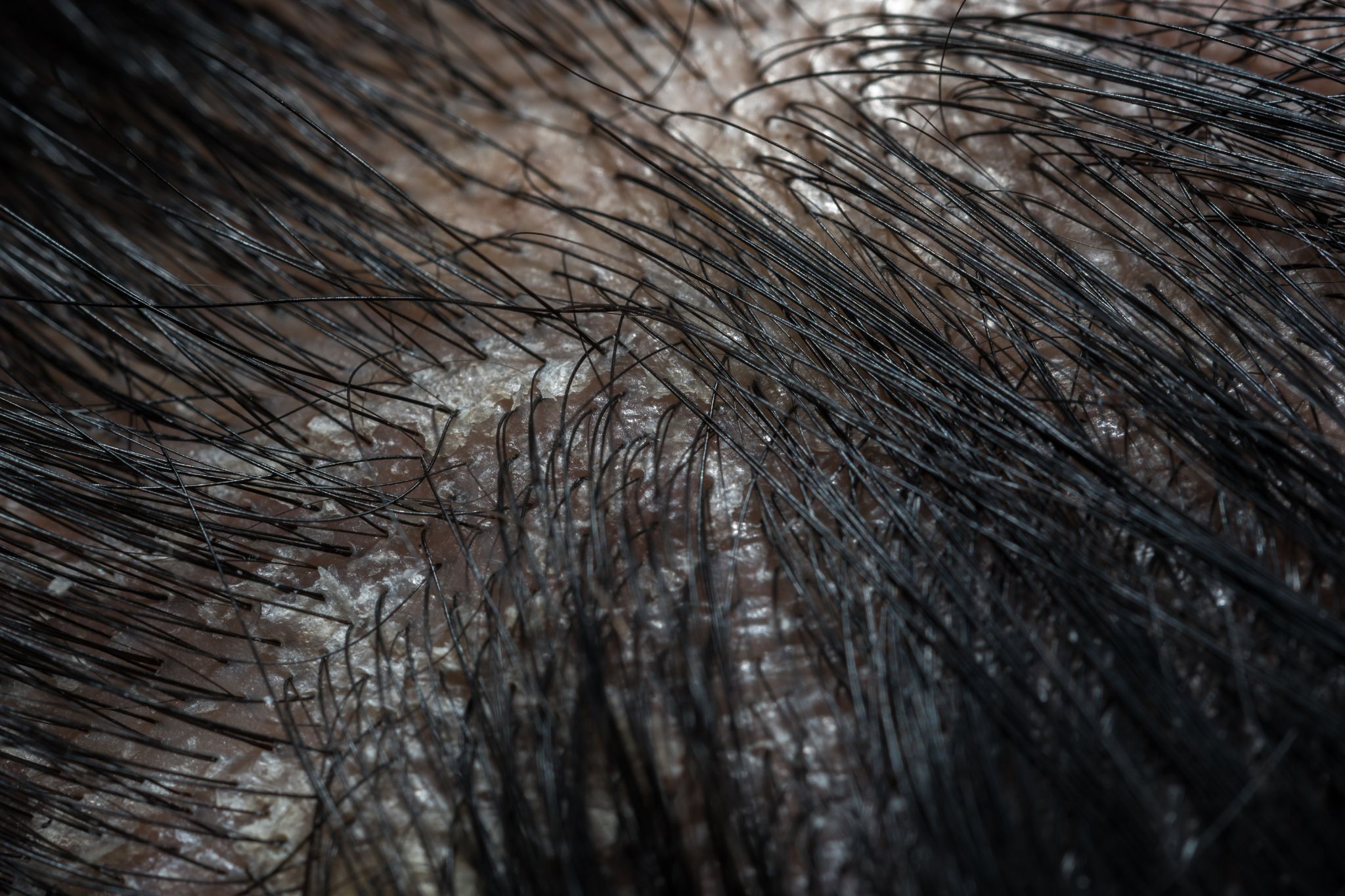 Pellicules grasses ou sèches : comment les traiter et soigner le cuir ...