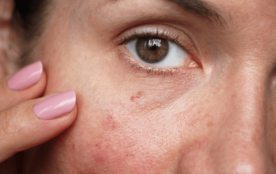 Routine peau sensible : quelle routine de soin pour une peau réactive