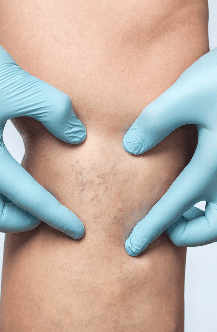 Varices et jambes lourdes : symptômes et traitement efficace