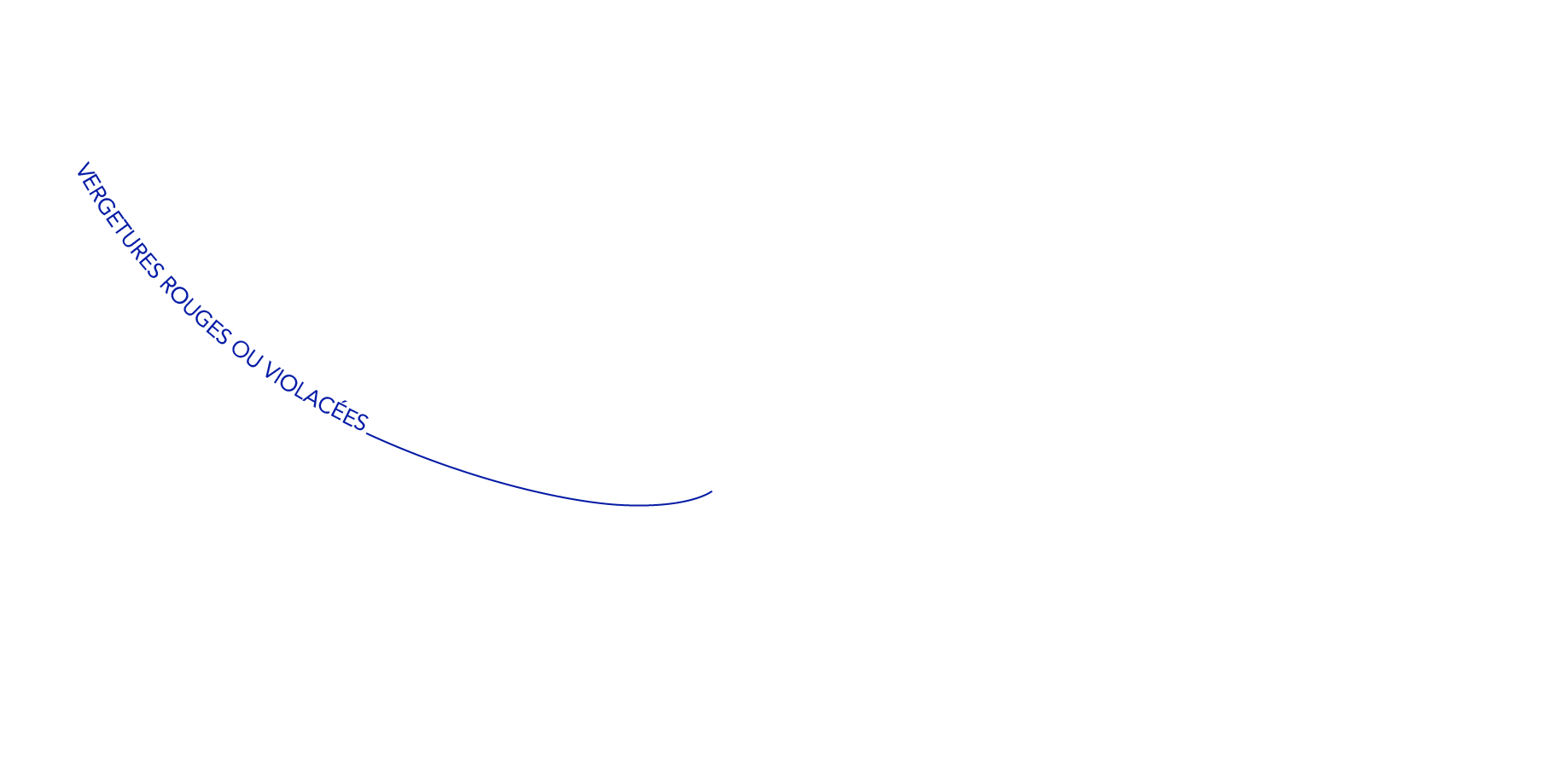 Dites adieu aux vergetures : Les meilleurs traitements