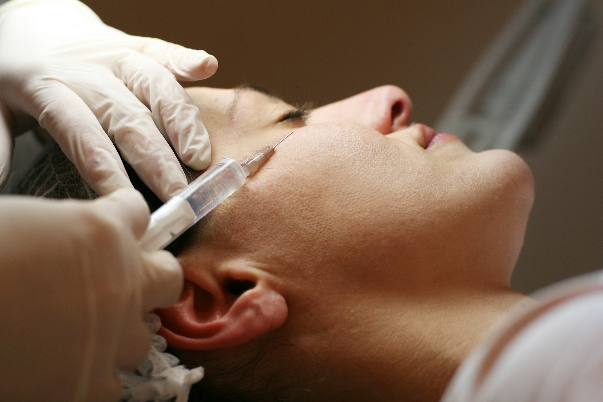Baby Botox : La nouvelle technique pour rajeunir son visage tout en douceur
