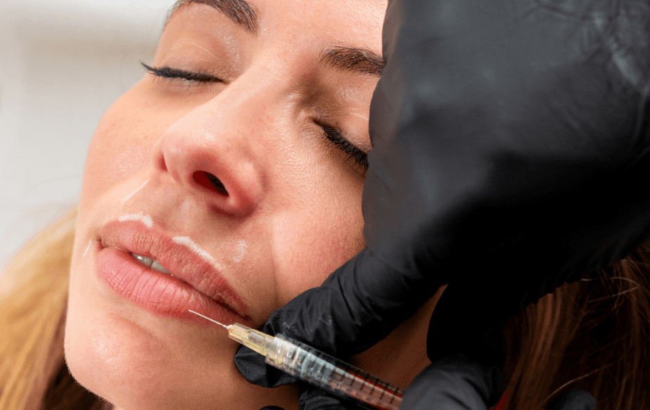 Injection d'acide hyaluronique Lille sur les lèvres | aesthé