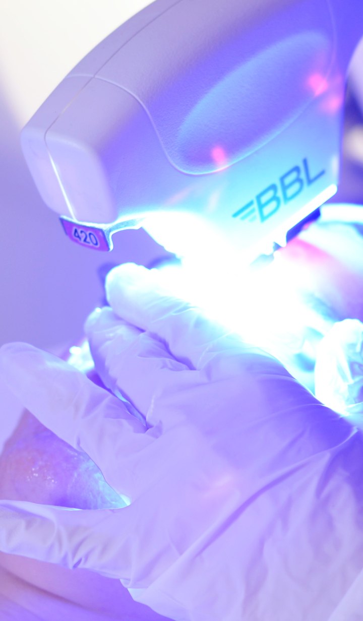 Laser BBL For ever young | Une peau rajeunie | aesthé