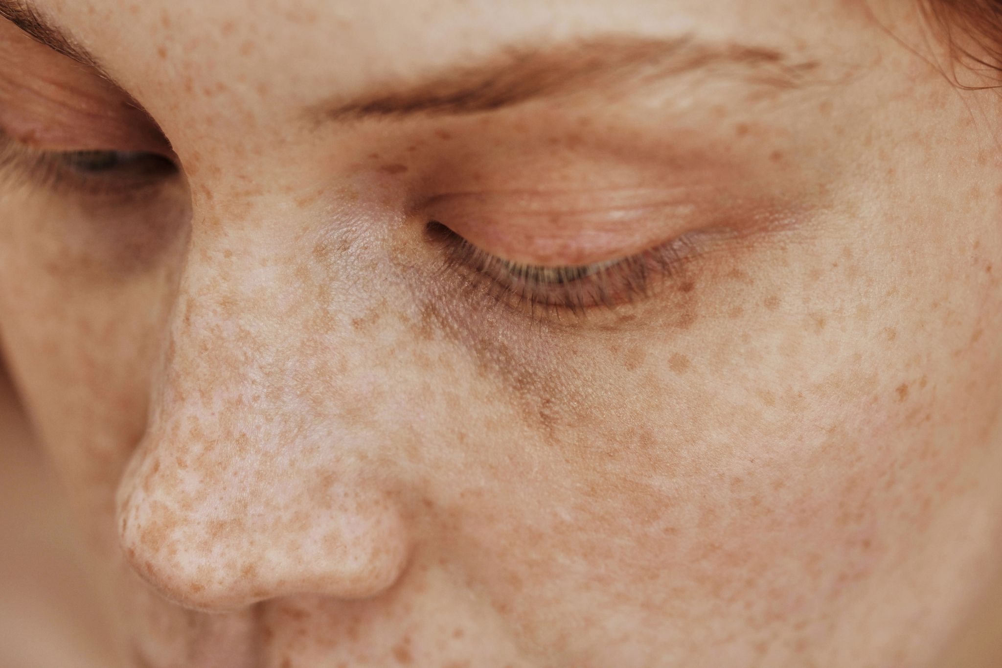 Laser pigmentaire : Le traitement des taches au laser au centre aesthé de Lille