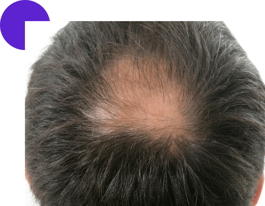 Tonsure et Calvitie : comprendre la perte de cheveux et agir