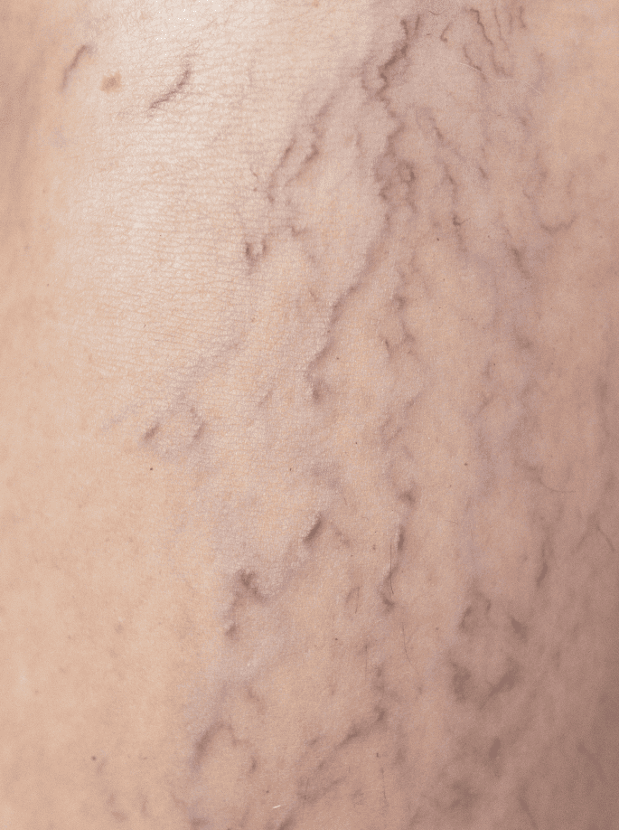 Varices oesophagiennes : causes, symptômes au foie et traitement