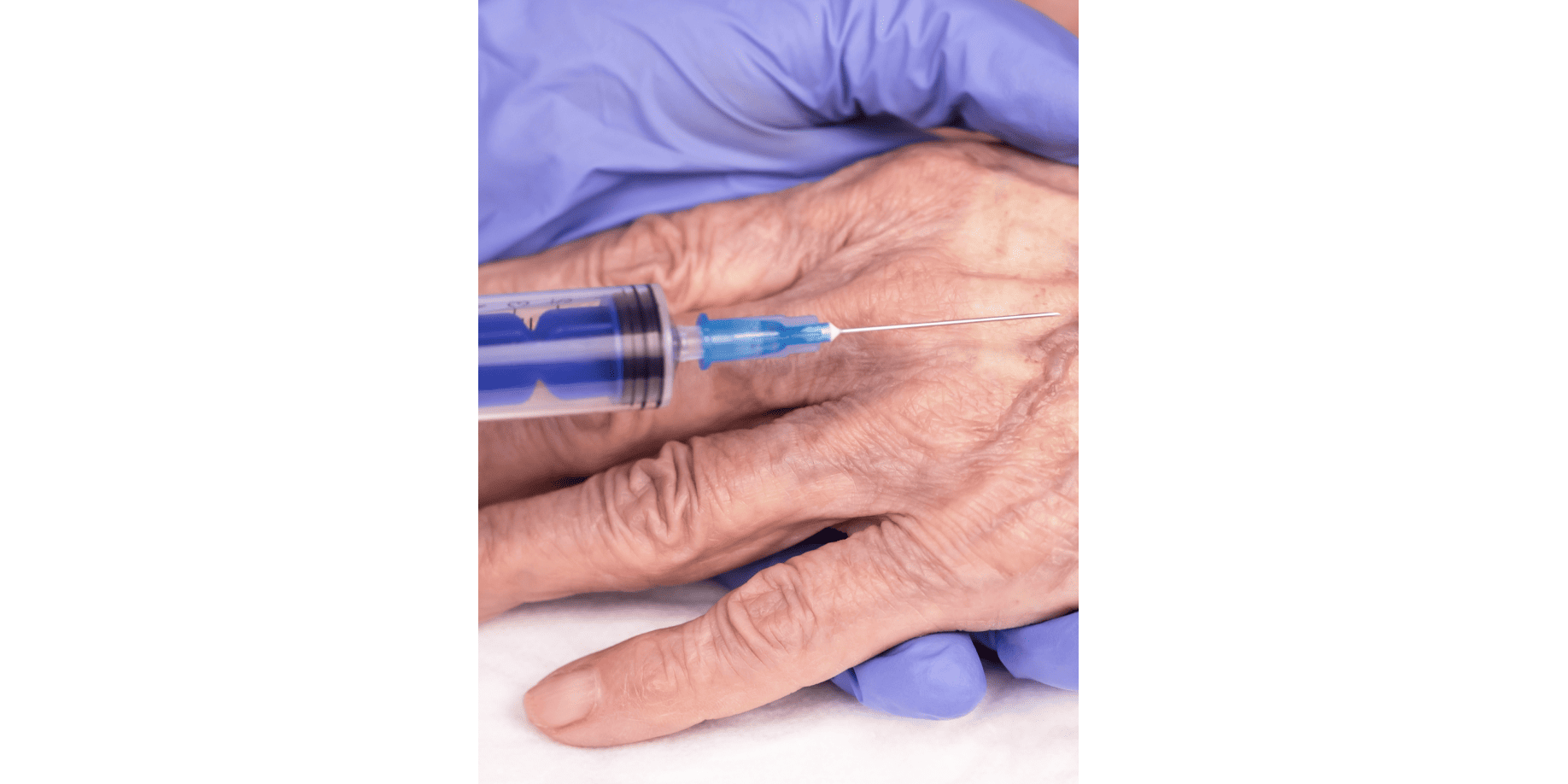 Les varices : symptômes, causes et traitement des varices