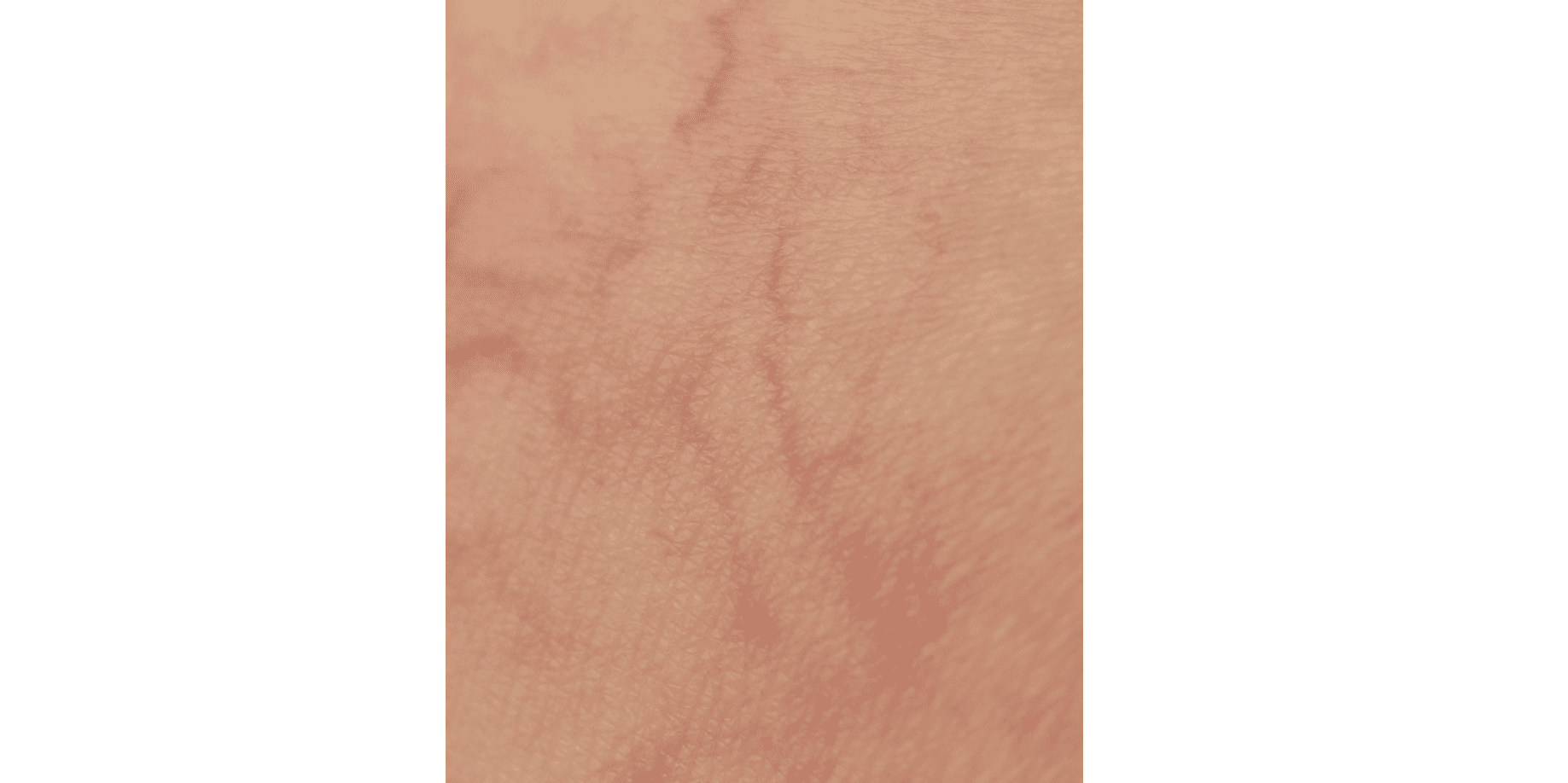 Varices pelviennes : tout savoir sur le syndrome de congestion pelvienne