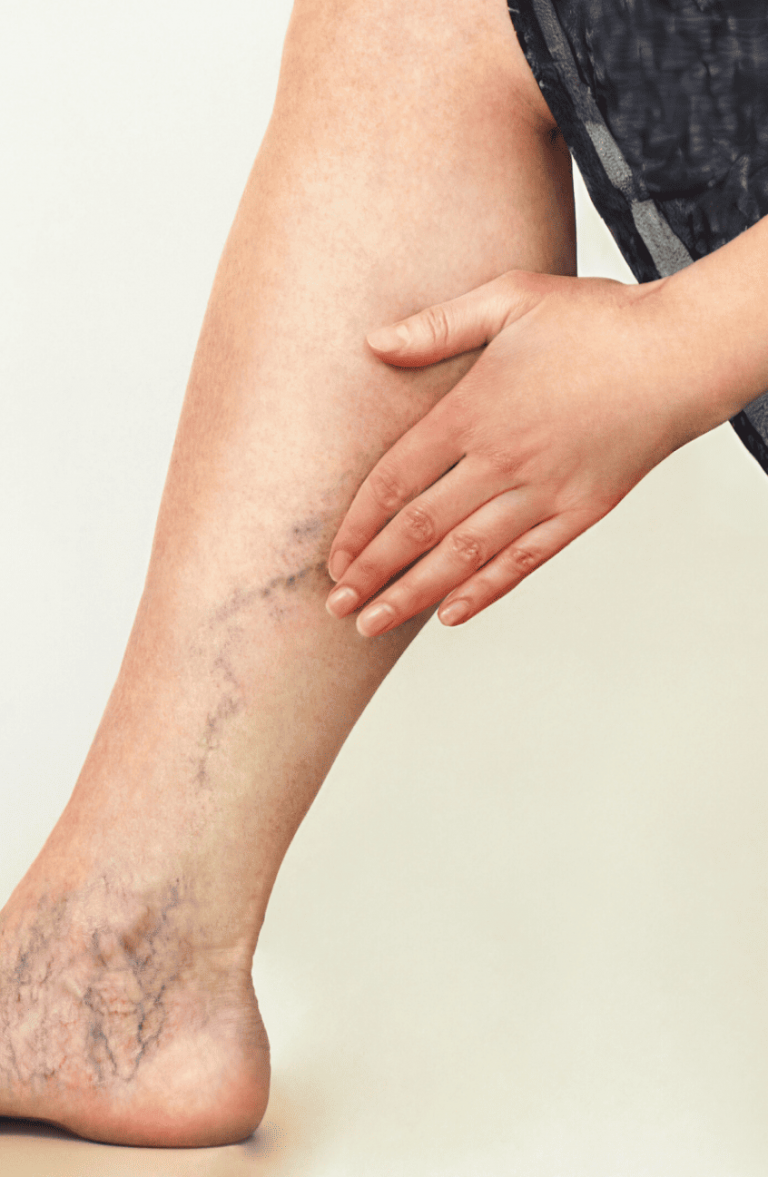 Varices et jambes lourdes : symptômes et traitement efficace